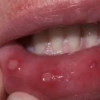 Best Mouth Ulcers Treatment | Clinic Eximus