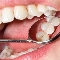 Dental Filling Services in Delhi | Tooth Filling