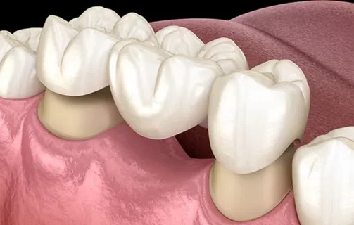 Top Crowns and Bridges Dental Clinic in Delhi | Clinic Eximus