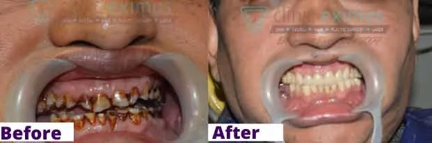 Best Full Mouth Rehabilitation | Clinic Eximus