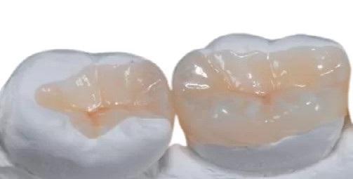 Top Crowns and Bridges Dental Clinic in Delhi | Clinic Eximus