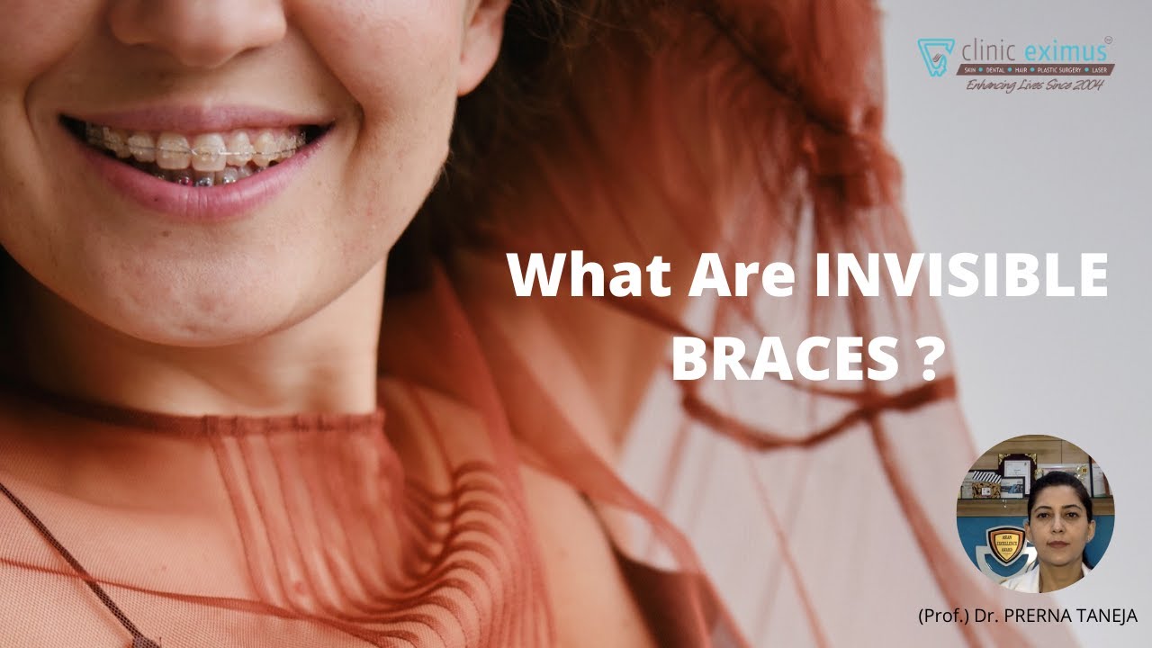 Invisible Braces In Delhi | Clinic Eximus